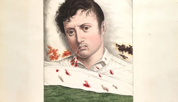 Diseases | History of Vaccines