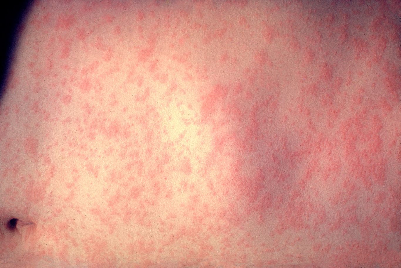 Measles | History of Vaccines